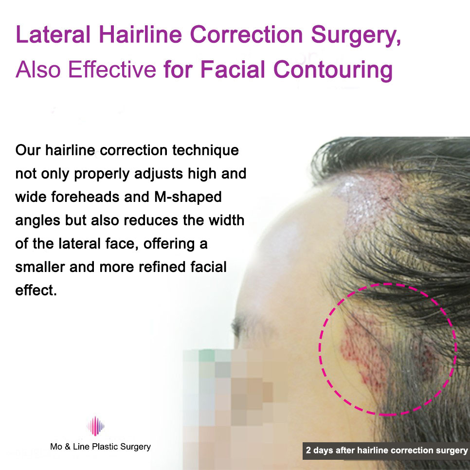 Small Face Lateral Hairline Correction at Mo & Line Plastic Surgery ...