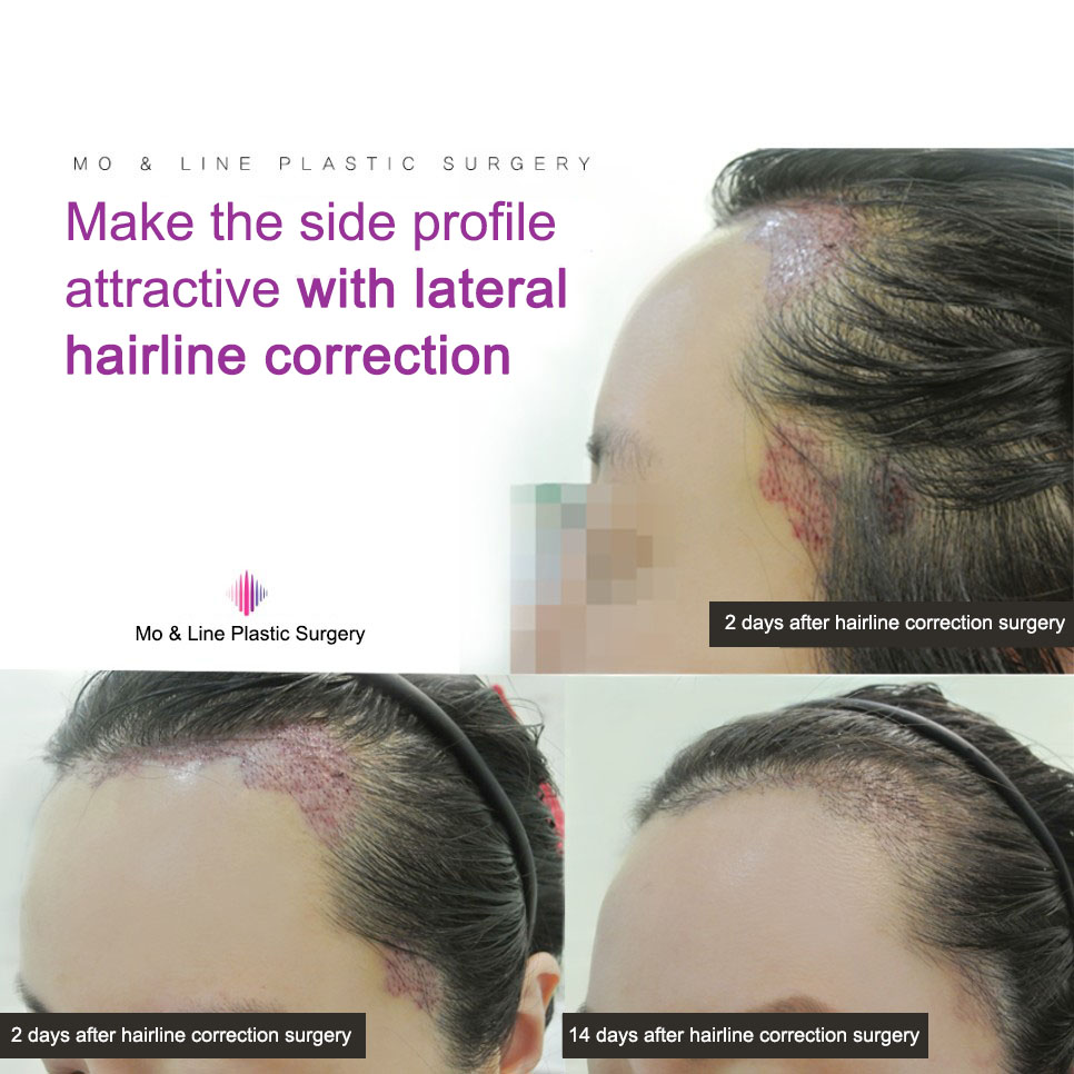 Small Face Lateral Hairline Correction at Mo & Line Plastic Surgery ...