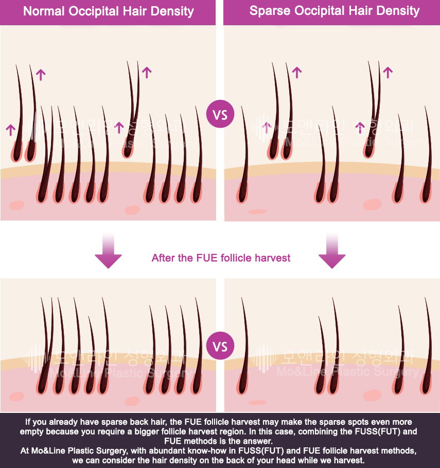 Mass Hair Transplants For Hairline Correction through the FUSS(FUT ...