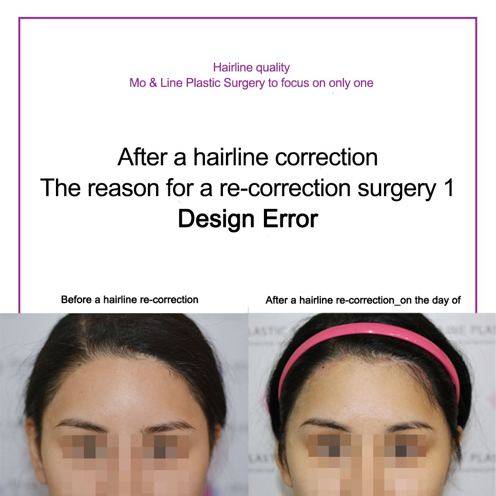 The Reason For A Re-correction Surgery after a Hairline Correction Pt ...