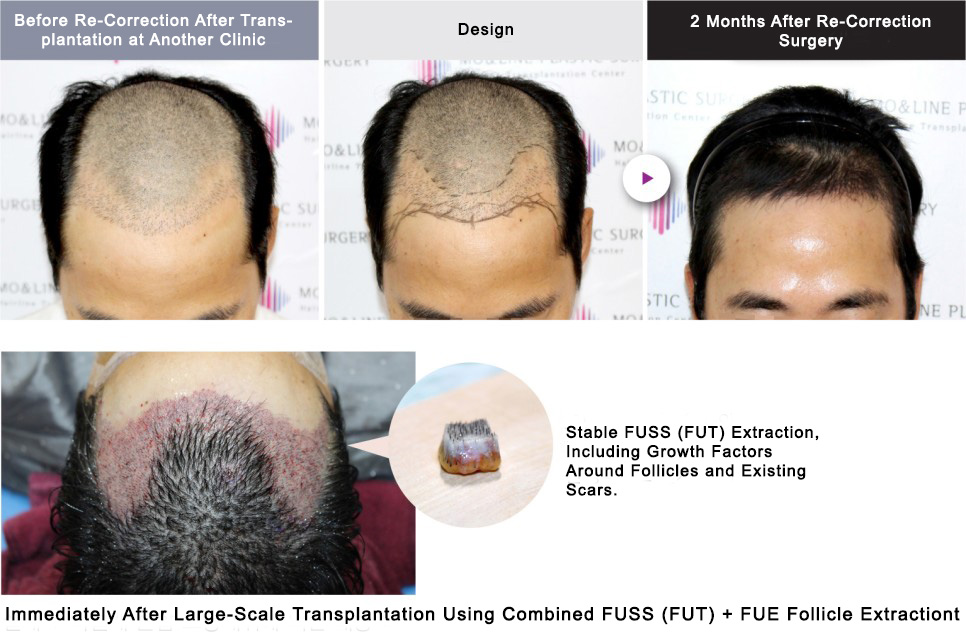 Why Do Men End Up Getting Hair Transplants After Semi-Permanent Tattoos ...