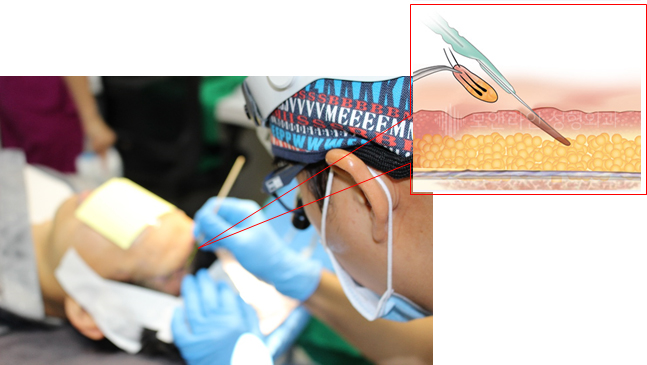 Choosing the Right Clinic for Male M-Shaped Hairline Transplant: A ...