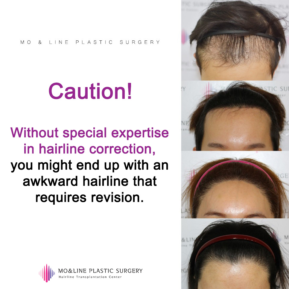 How to Successfully Redo a Failed Hairline Correction: Important Points ...