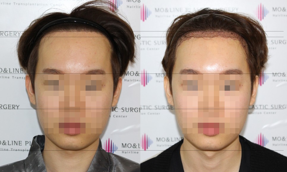 Revising an Awkward Hairline and Covering Surgical Scars after Male ...