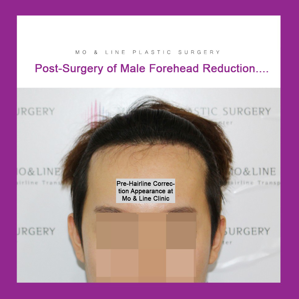 Revising an Awkward Hairline and Covering Surgical Scars after Male ...