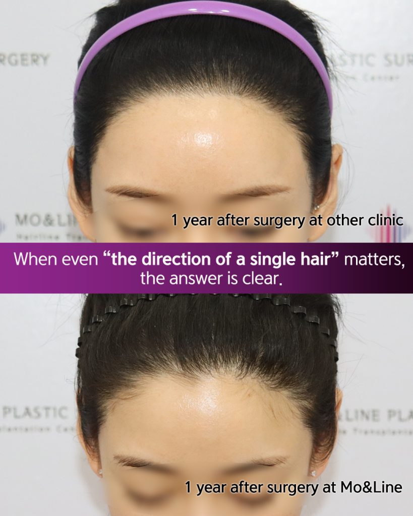 Why Hairline Transplantation Is About More Than Just a Lower Hairline ...