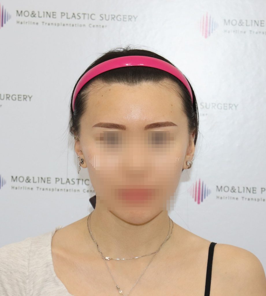 Patient Review│Transforming a Deep M-Shaped, Wide Forehead into a ...