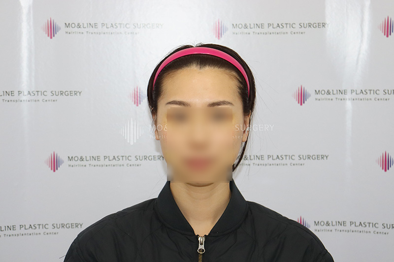 Patient Review│Natural-Looking Female Hairline Correction Hair ...