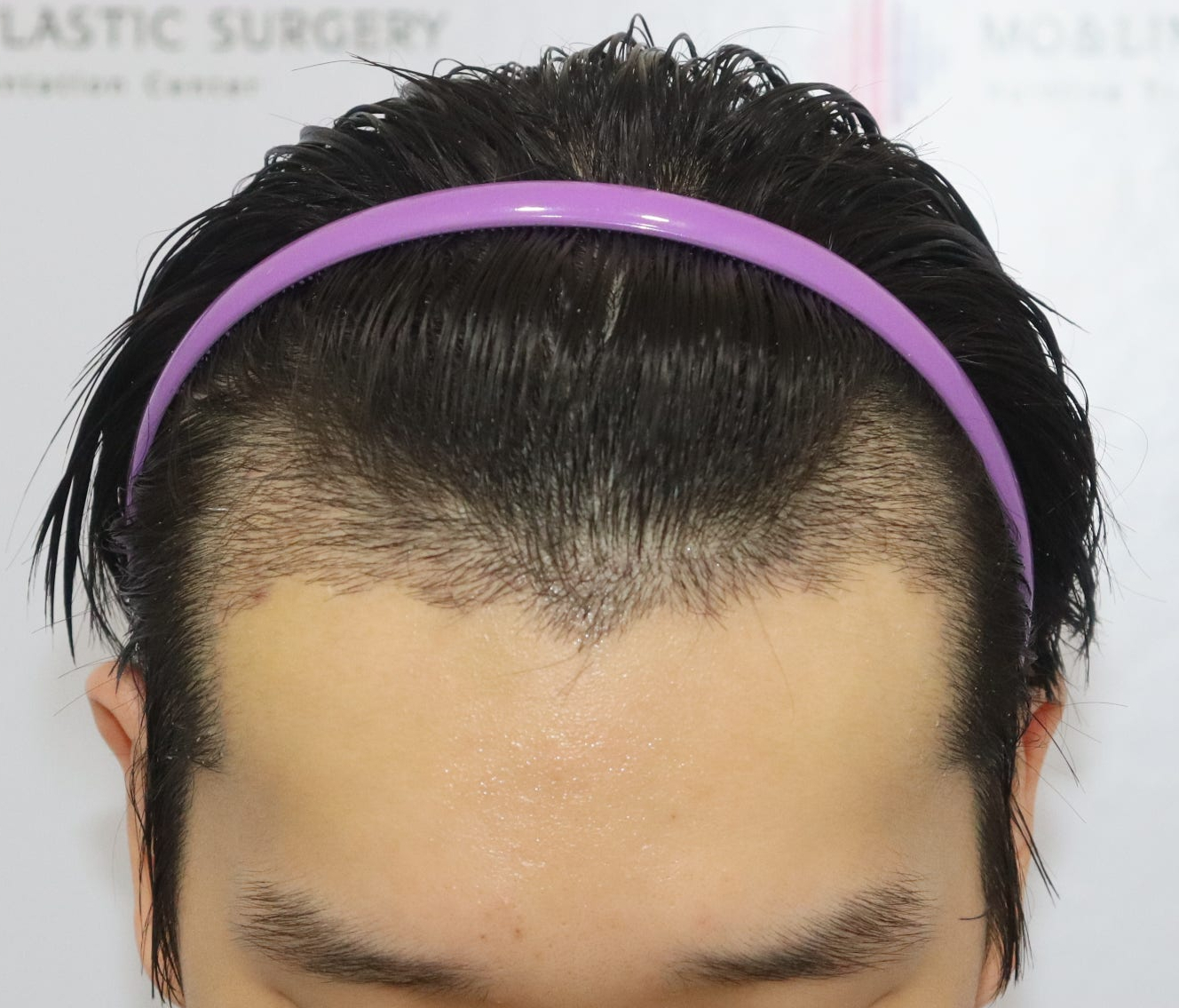 Patient Review│Early 20s M-Shaped Hair Loss 2-Week Progress of a London ...