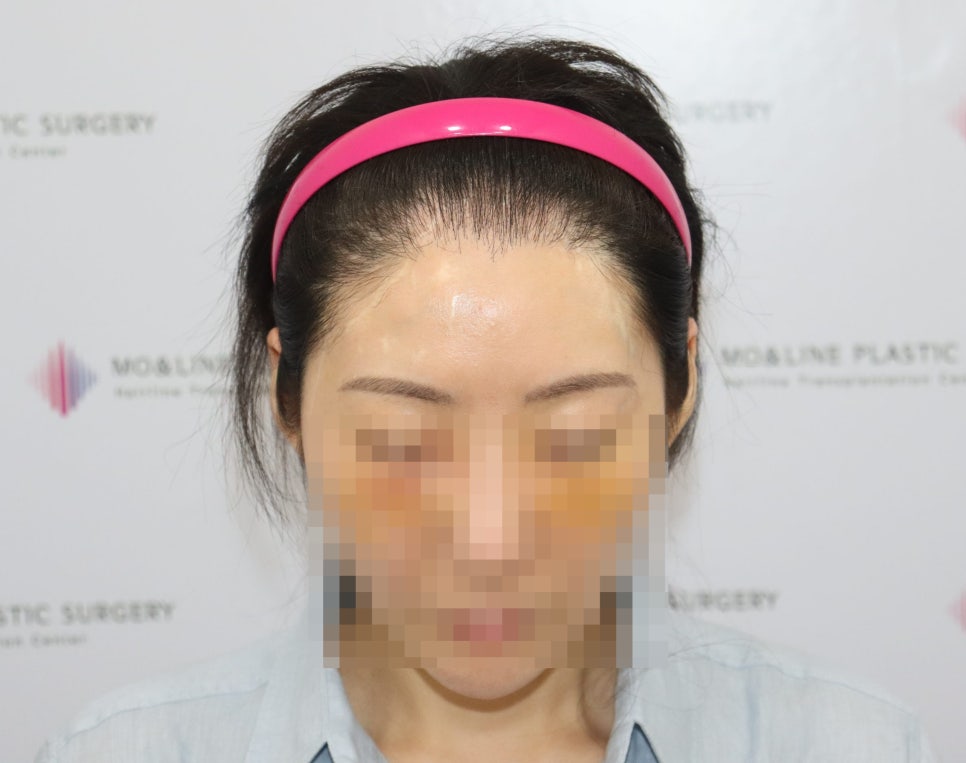 Patient Review│Forehead Scar & Hair Transplant from 10 Years Ago ...